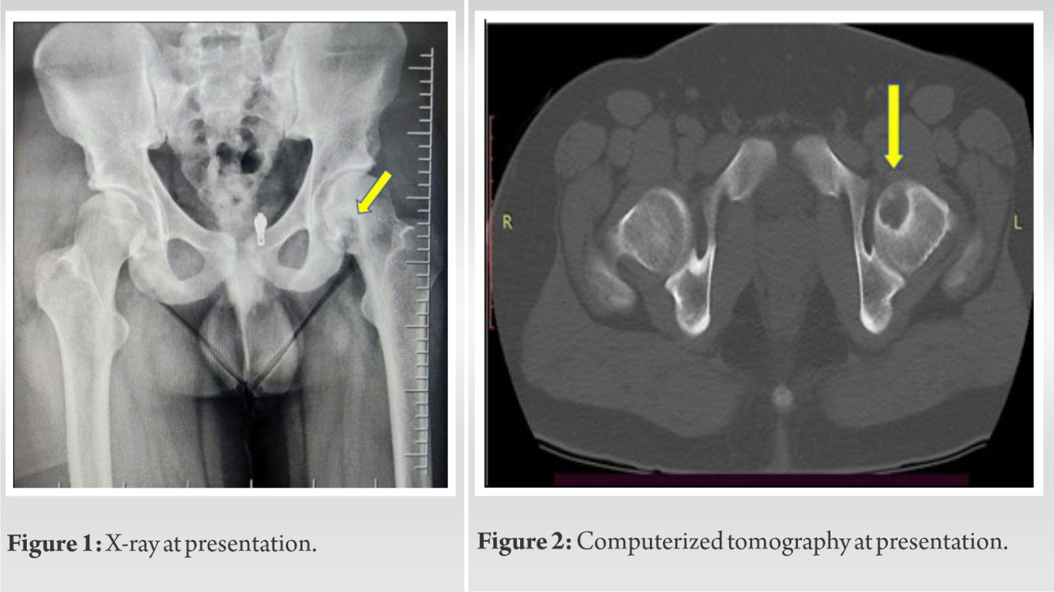 A Rare Occurrence of Enchondroma in the Head of Femur in an Adult Male ...