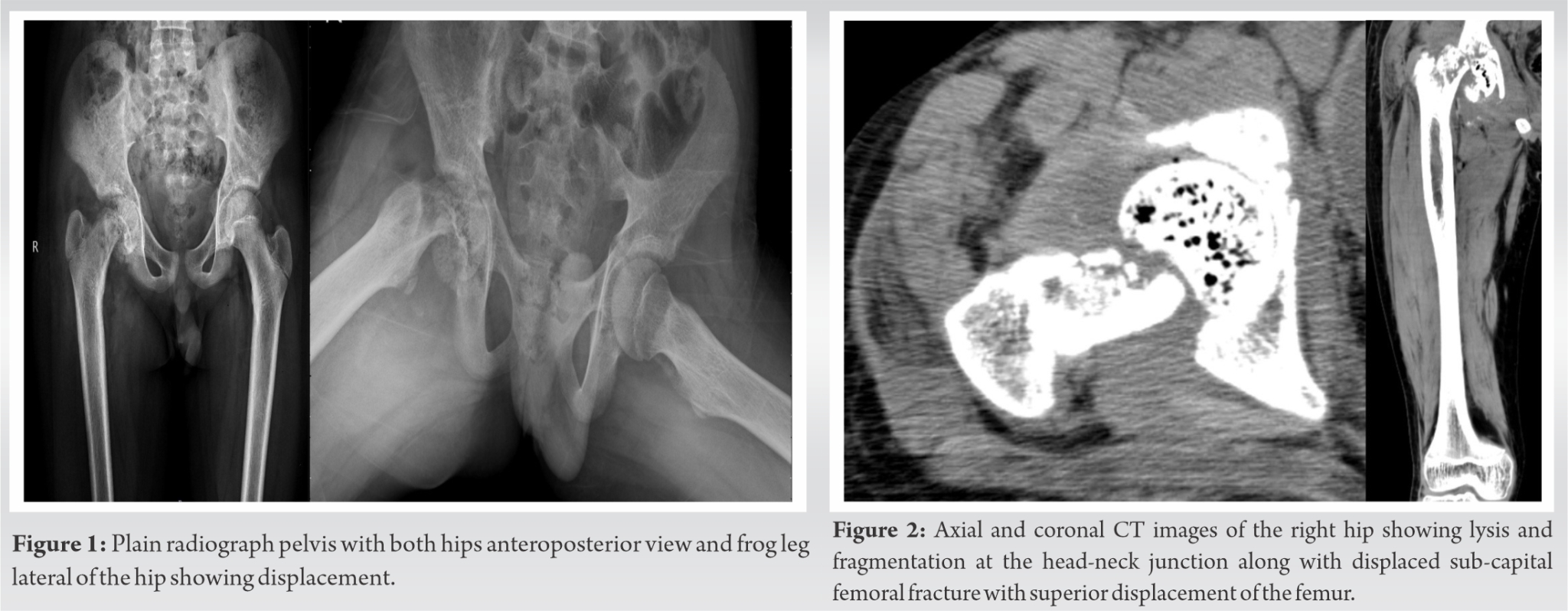 Subacute Bacterial Infection Mimicking a Slipped Capital Femoral ...