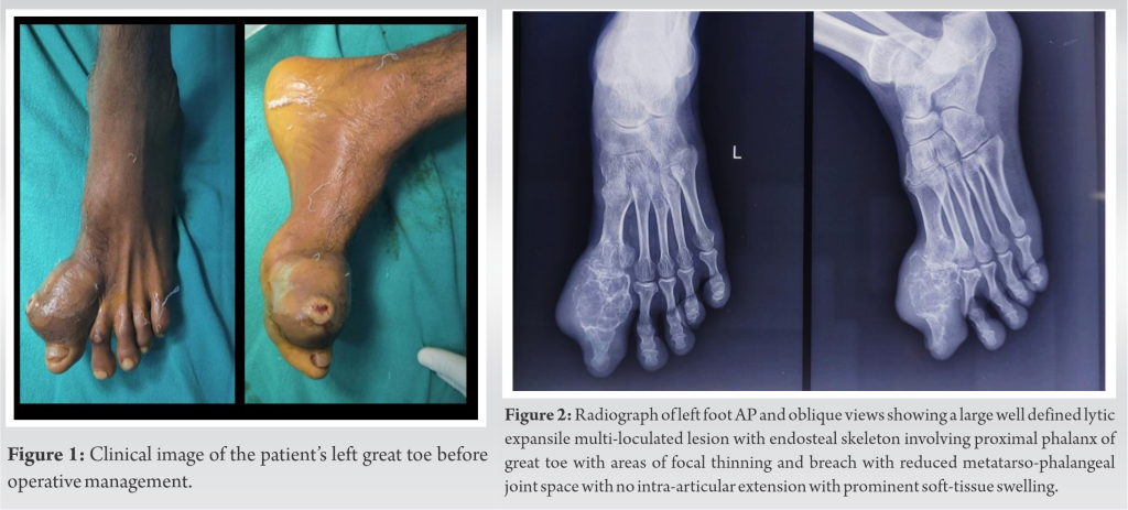 Chondrosarcoma of Great Toe: A Case Report | Journal of Orthopaedic ...