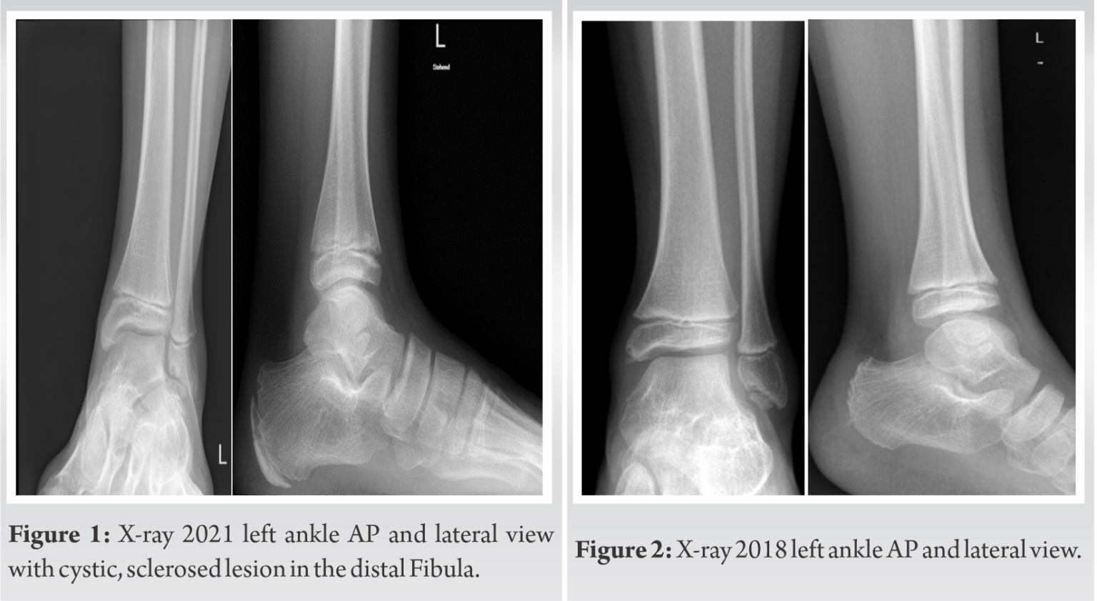 X Ray Ankle Ap