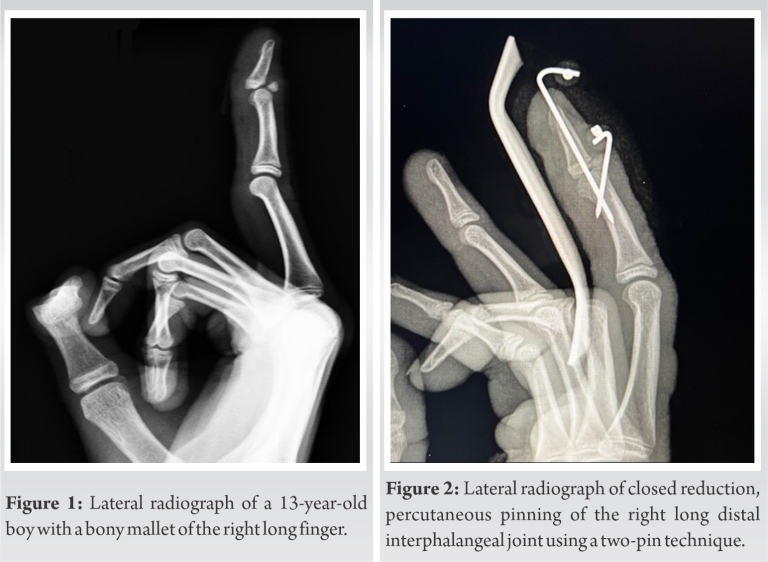 Mallet Finger Autofusion in Adolescent Post-Pin Fixation Surgery – A ...