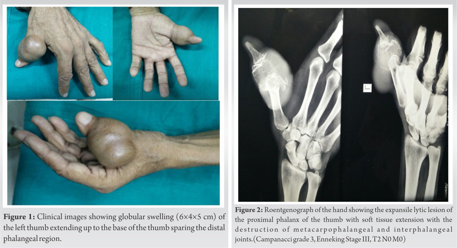 Giant Cell Tumor of Thumb Proximal Phalanx-A Case Report | Journal of ...