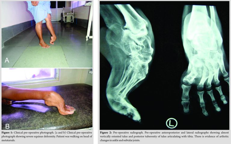 Single-Stage Correction of Severe Rigid Ankle Equinus Deformity by ...