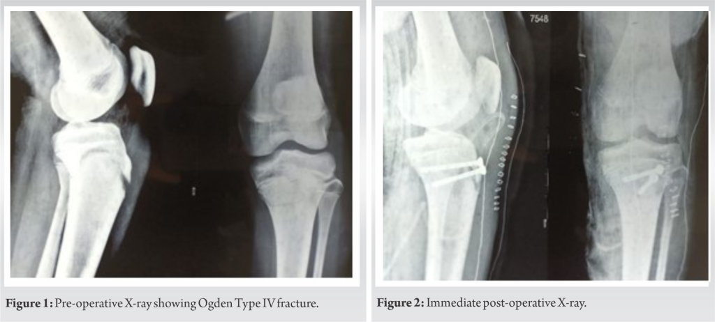 A Type IV Tibial Tuberosity Avulsion Fracture in an Adolescent – A Case ...