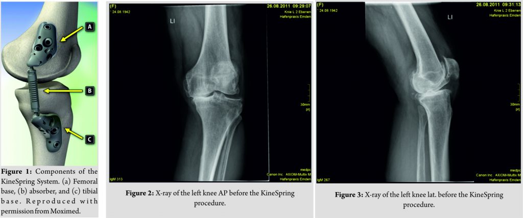 A Case Report of the Successful Conversion of One of the Longest ...