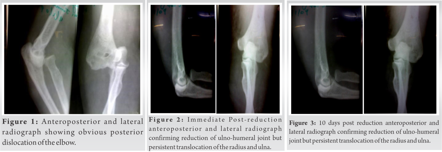Combined Posterior and Convergent Elbow Dislocation in Adult: A Rare ...