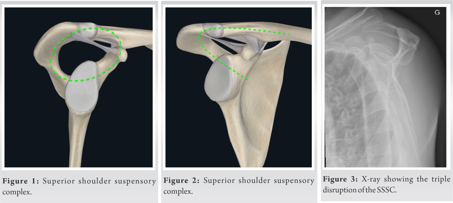 Triple Disruption of the Superior Shoulder Suspensory Complex: review ...