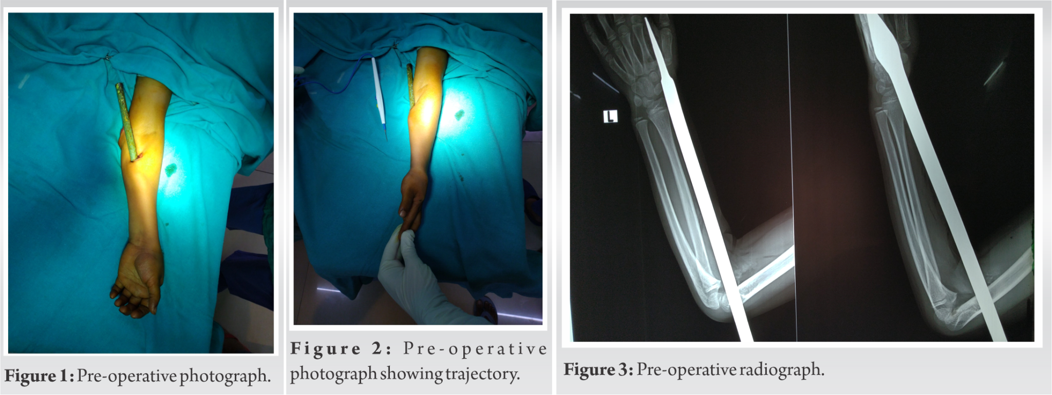 Pediatric Forearm Impalement Injury: A Case Report with Review of ...