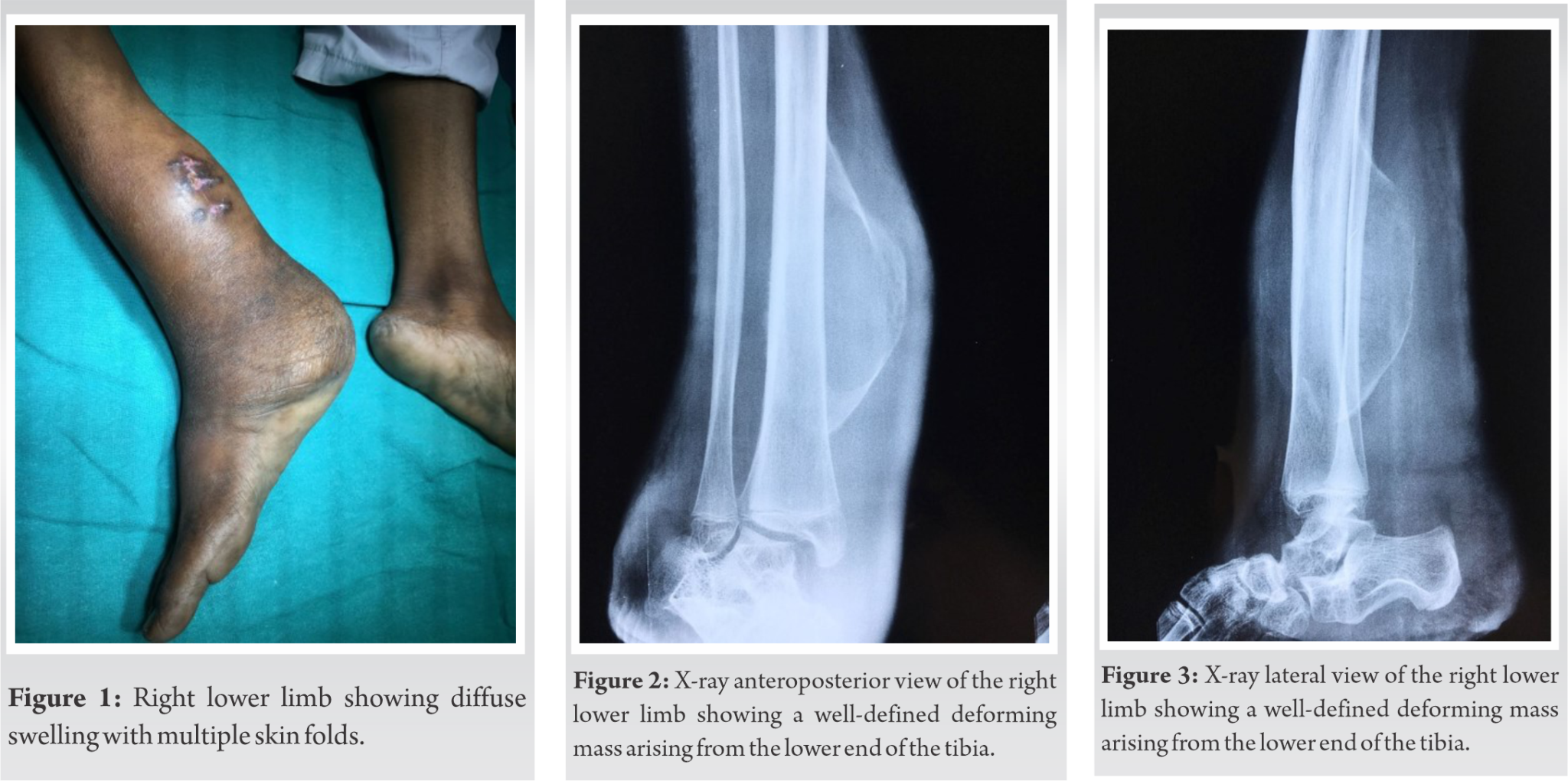 Tibial Dysplasia in Neurofibromatosis-1: A Rare Case Report and Review ...