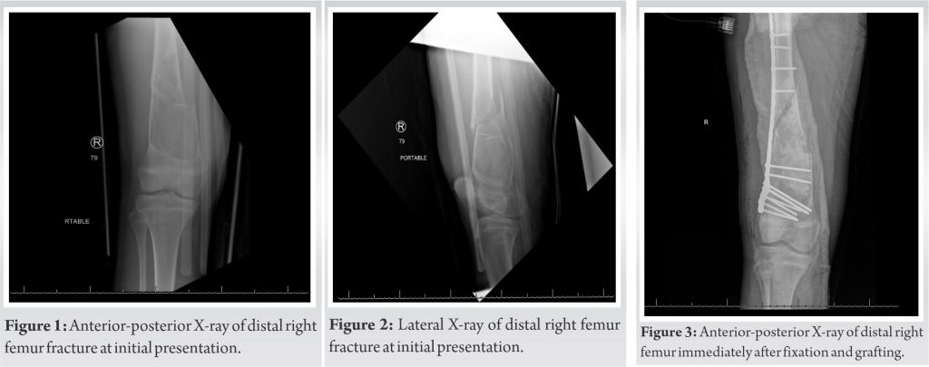 Operative Treatment of a Patient with a Pathological Fracture through a ...