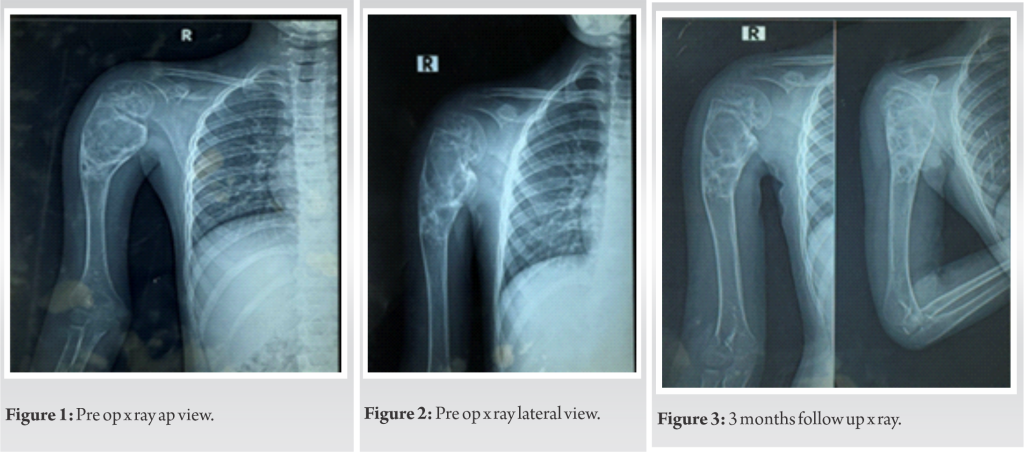 Sclerotherapy as a Primary or Salvage Procedure for Aneurysmal Bone ...