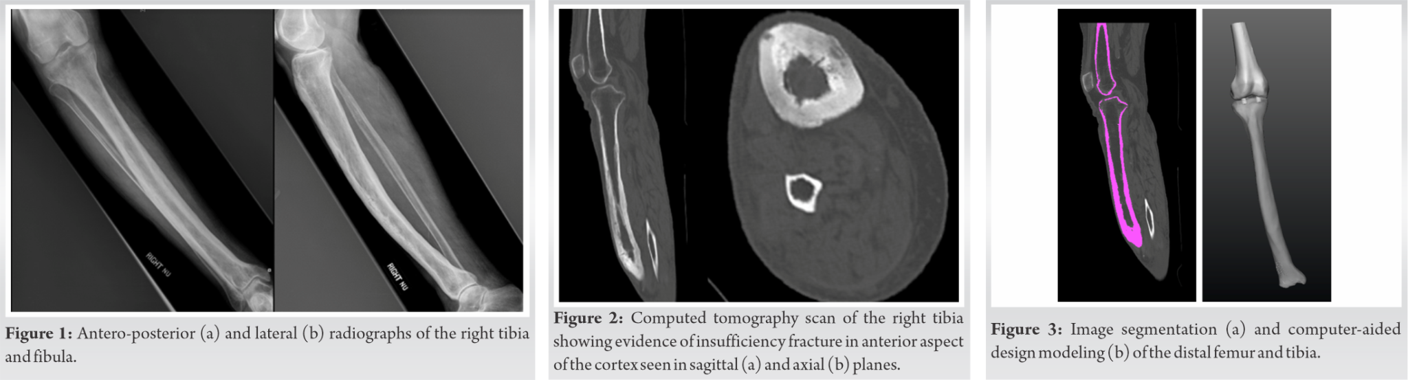 Fig 1 2 3 Journal Of Orthopaedic Case Reports Fig 1 2 3 Journal Of Orthopaedic Case Reports