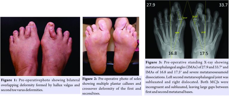A Case Report of Spontaneous Second Toe Varus Deformity Correction ...