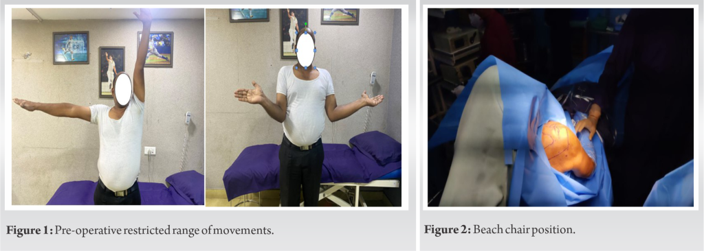 Percutaneous Capsule Release in Adhesive Capsulitis with Nanoscope ...