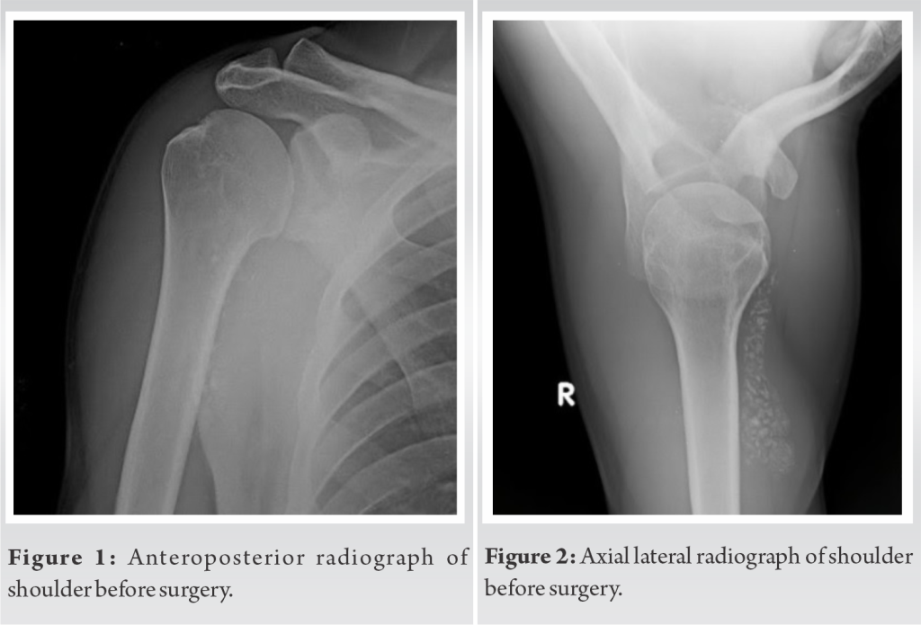 Unusual Case of Long Head of Biceps Tendon Synovial Chondromatosis ...