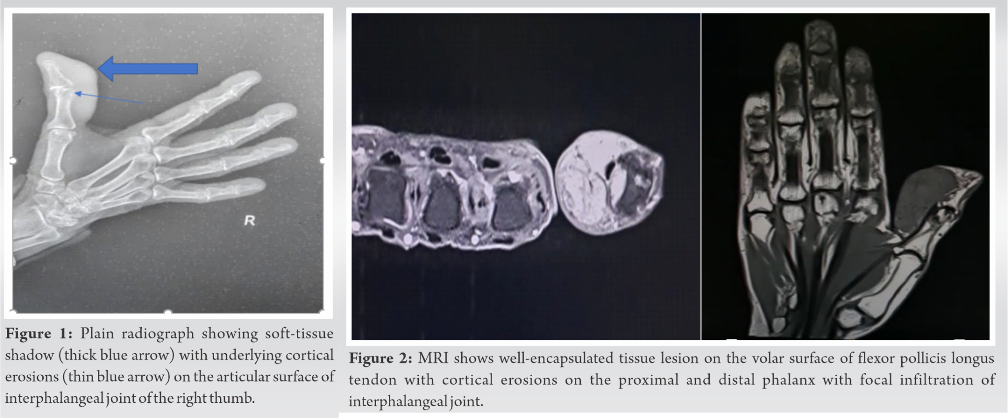 Giant Cell Tumor of Flexor Pollicis Longus Tendon Sheath: An Uncommon ...