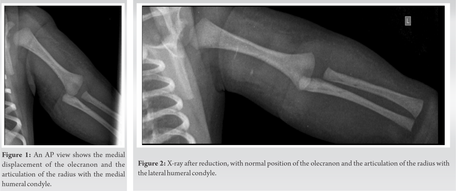 Neonatal Transphyseal Separation of the Distal Humeral Epiphysis: Early ...