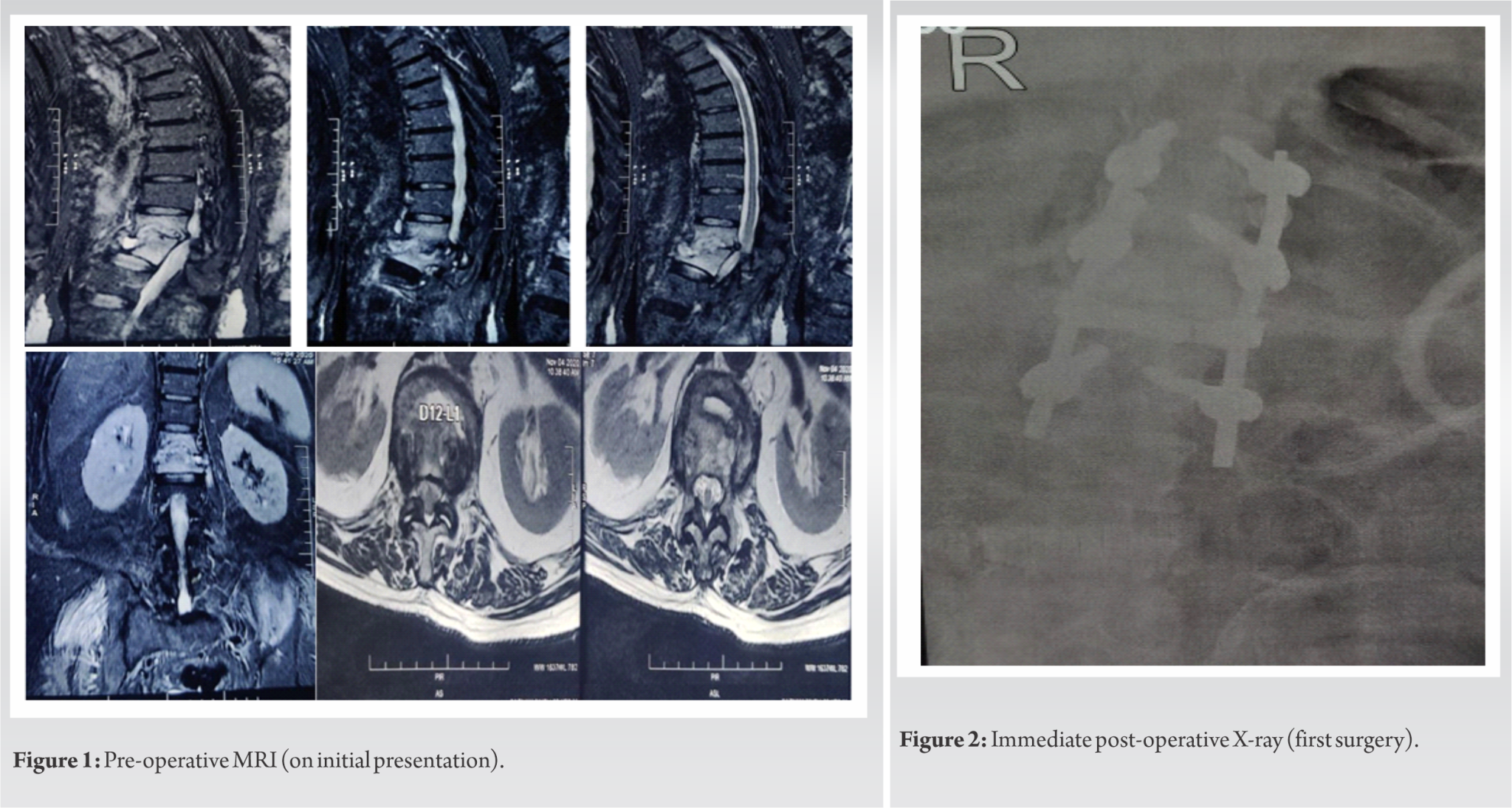 Subjacent Disease in an Operated Case of Spinal Tuberculosis: A Case ...