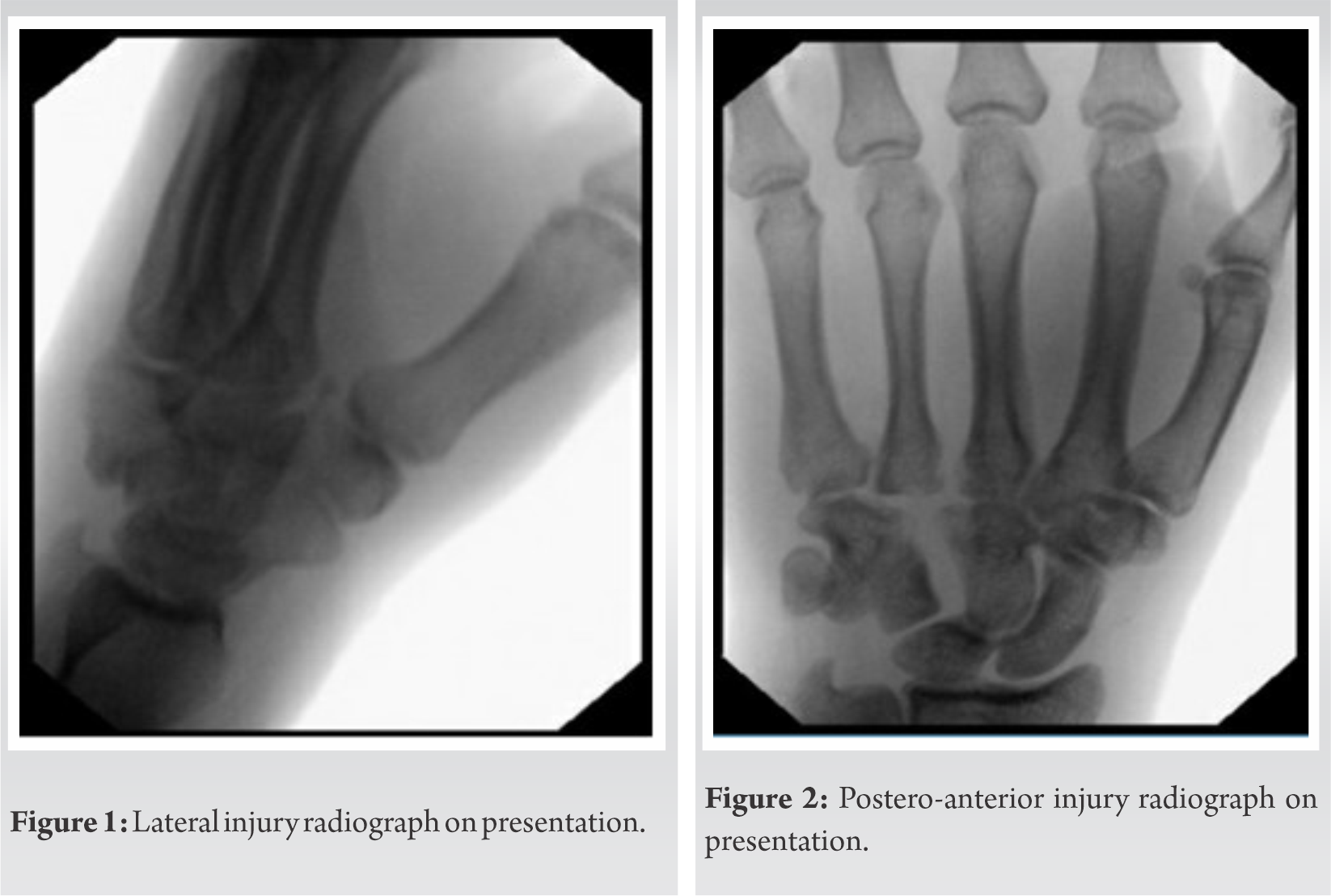 Isolated Hamate Dislocation: A Case Report and Technique Guide | Journal of Orthopaedic Case Reports