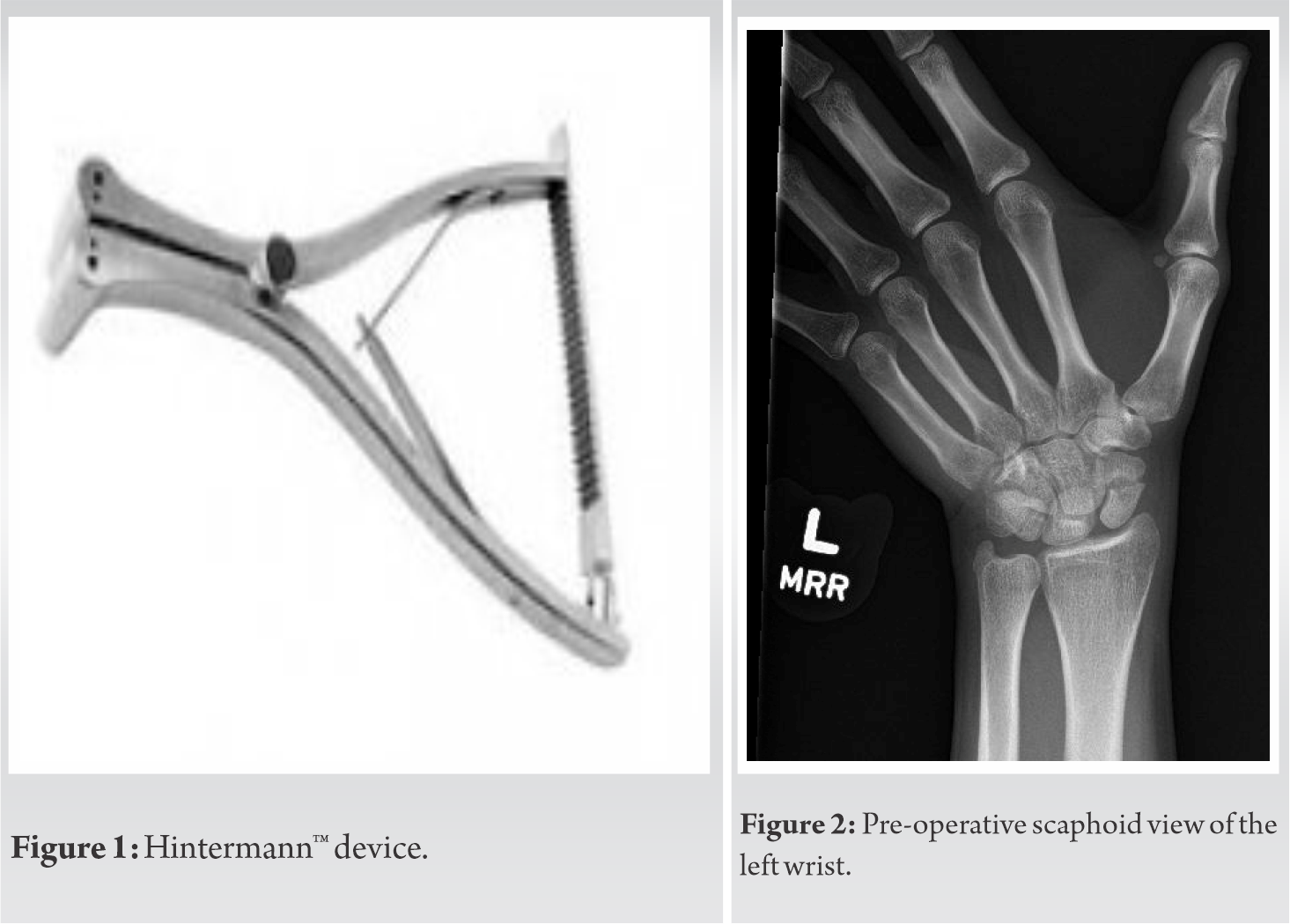 The Integration of Foot and Ankle Instruments to Enhance Orthopedic ...