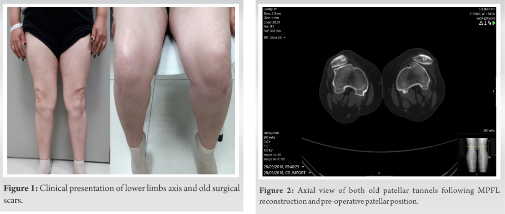 Patellofemoral Arthroplasty for Irreducible Chronic Bilateral Patella ...