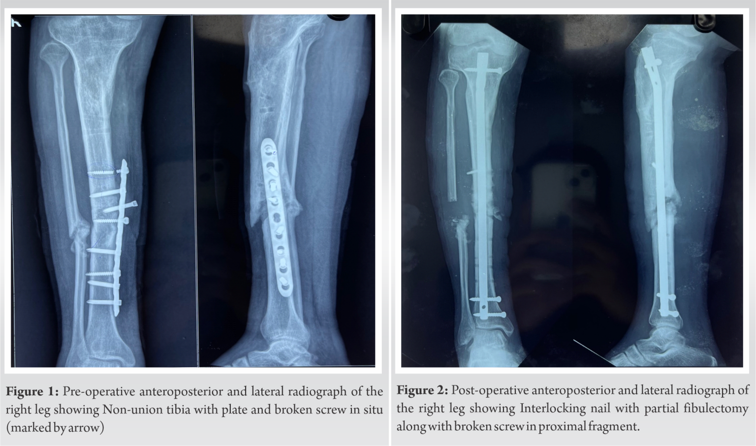 Peroneal Artery Pseudoaneurysm after Surgery for Non-union of Tibia: A ...