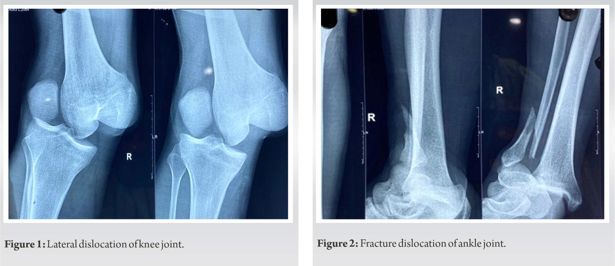 Ipsilateral Knee Dislocation and Ankle Fracture Dislocation | Journal ...