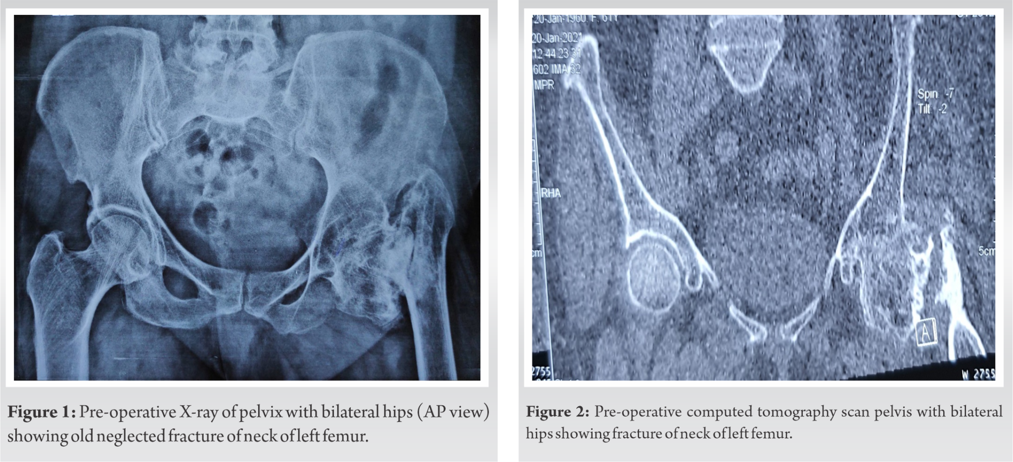 Management of Thrombosis of the External Iliac Artery during Total Hip ...