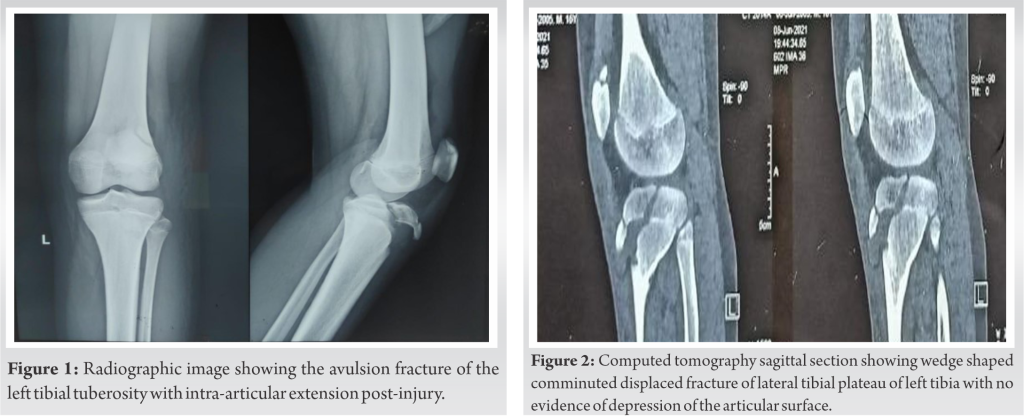 Tibial Tuberosity Avulsion Fracture with Epiphyseal Injury in a Soccer ...