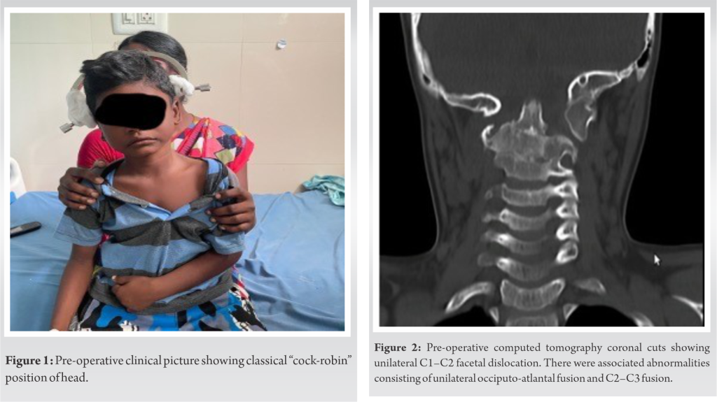 A Rare Case of Grisel’s Syndrome in A 6-Year-Old Child | Journal of ...