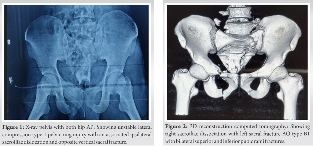 Triangular Osteosynthesis as a Surgical Treatment Option for Unstable ...