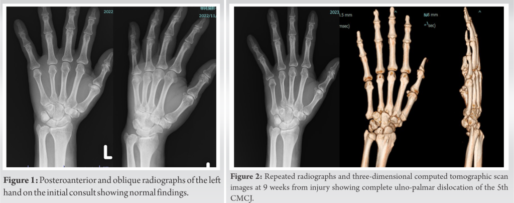 Use of Mini TightRope® for Delayed Presentation of a Fifth ...