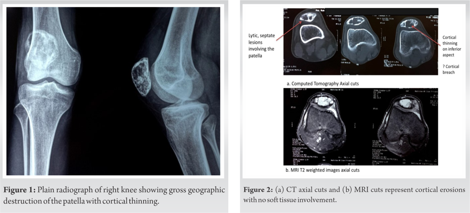Giant Cell Tumor of Patella with Secondary Aneurysmal Bone Cyst-A Rare ...