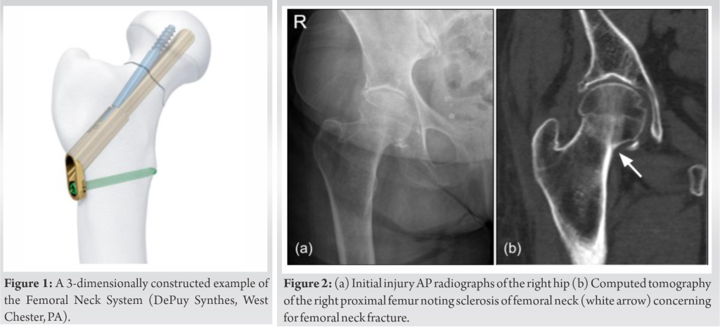 Peri-Implant Fracture Following Prior Fixation of Femoral Neck Fracture ...