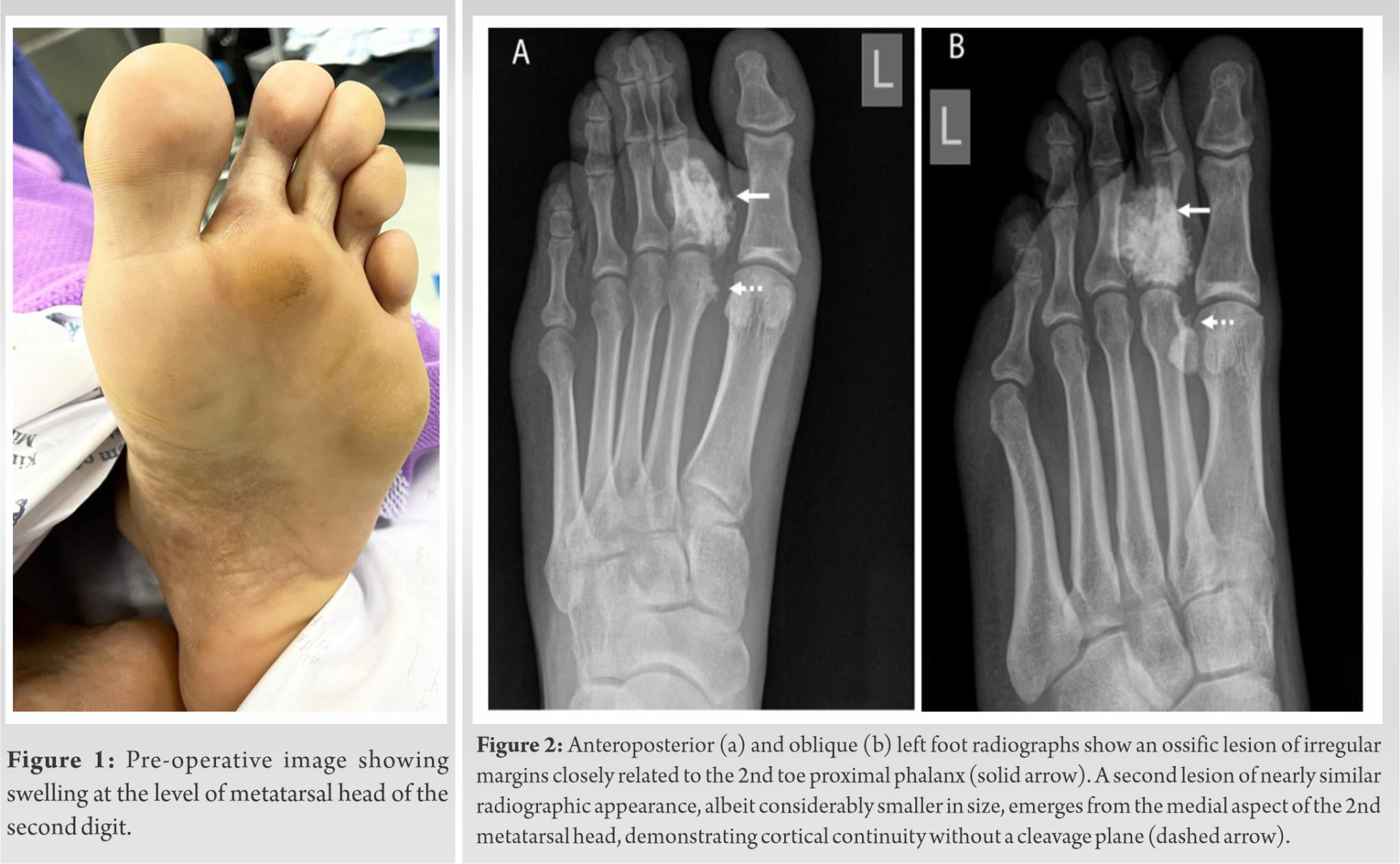 Bizarre Parosteal Osteochondromatous Proliferation (Nora’s Lesion) Of ...