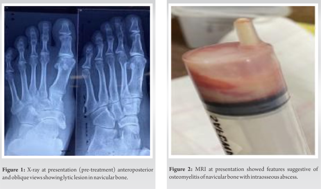 Tubercular Osteomyelitis of Navicular Bone: A Rare Site for Bone ...