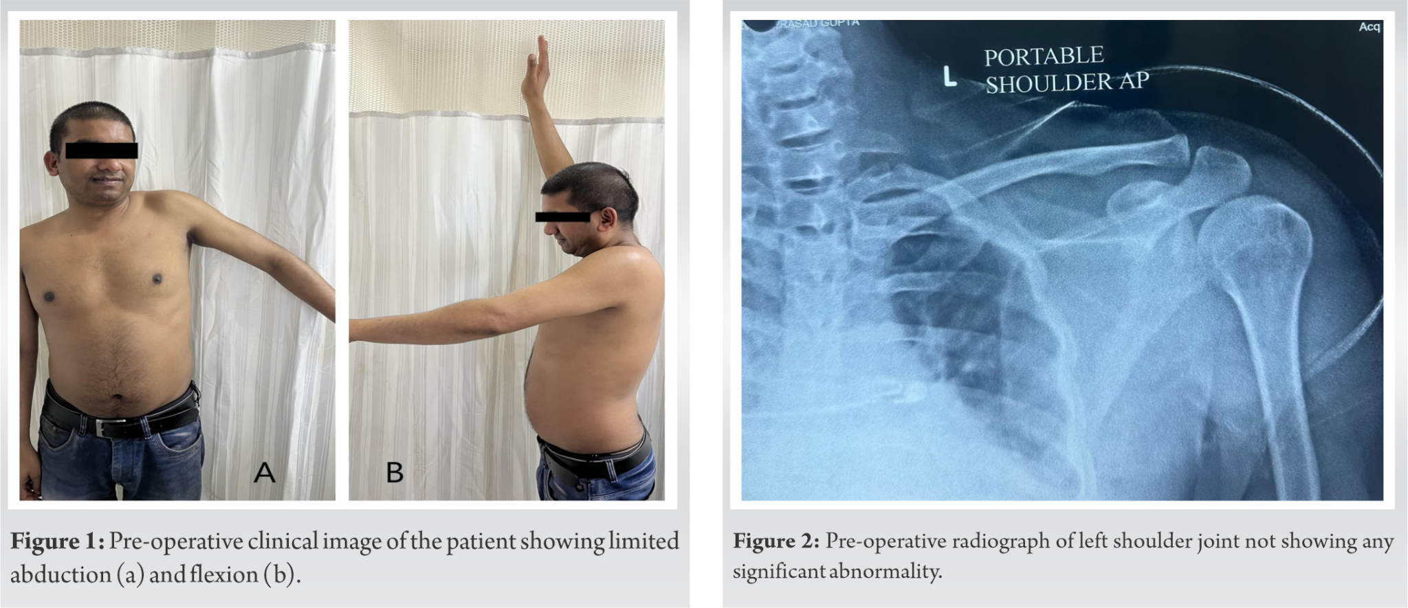 Comprehensive Evaluation and Arthroscopic Management of Circumferential ...
