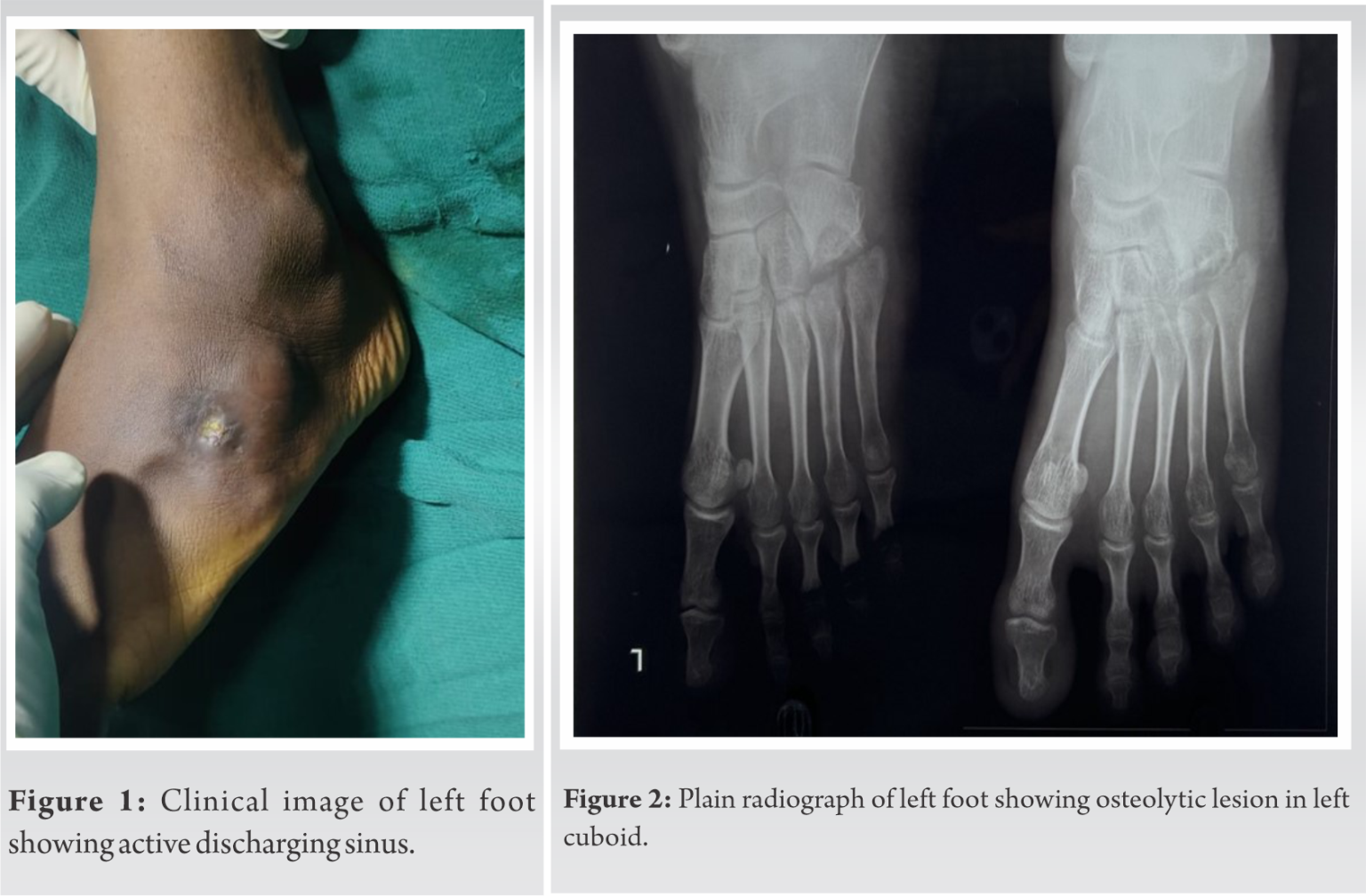 Chronic Tuberculous Osteomyelitis of Cuboid: A Case Report | Journal of ...