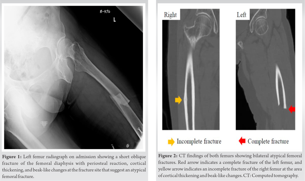 Impending Atypical Femoral Fracture on the Contralateral Side ...