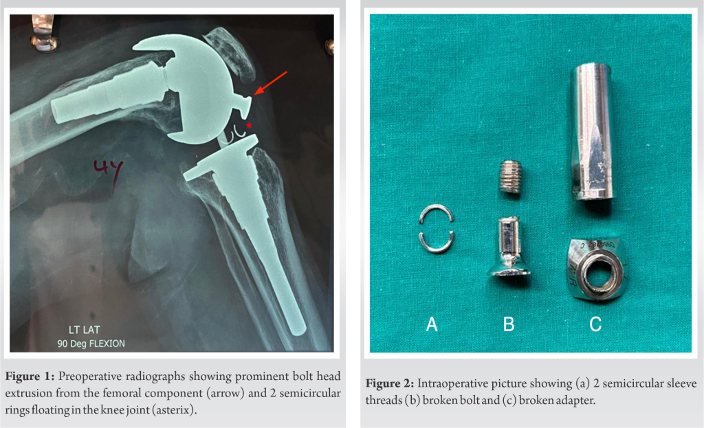 Mechanical Failure of SIGMA Total Condylar-III Revision Total Knee ...