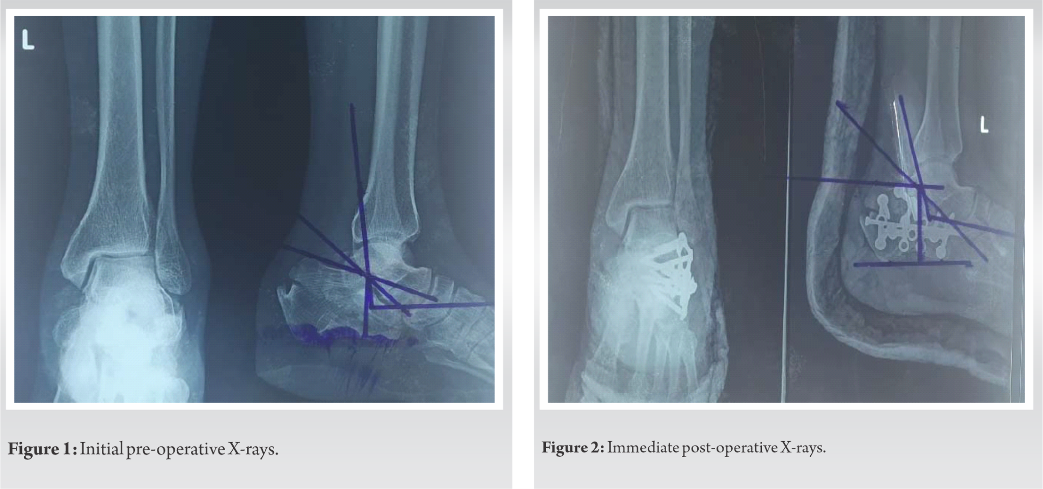 Functional and Radiological Outcome after Internal Fixation of Intra ...