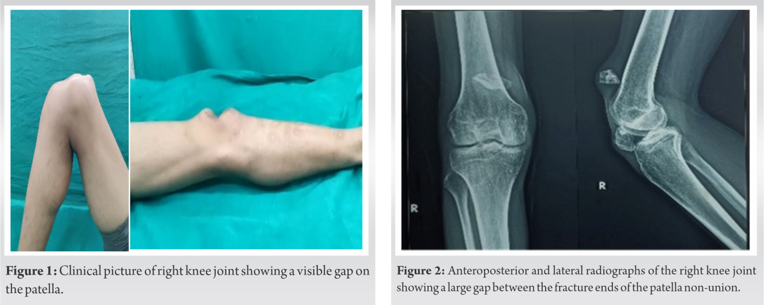 Non-union Patella Fracture – Extensor Mechanism Repair with Quadriceps ...