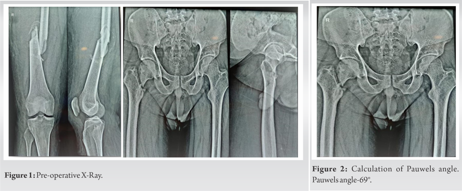 Neglected Ipsilateral Non-Union Neck of Femur with Shaft of Femur Non ...