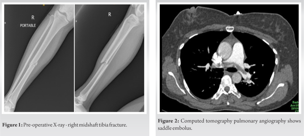 DVT with Pulmonary Embolism in Patient with Grade 2 Compound Tibia ...