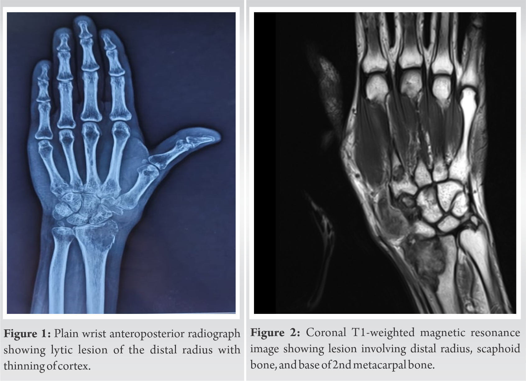 Multifocal Epitheloid Hemangioma of the Bone – A Rare Entity | Journal ...