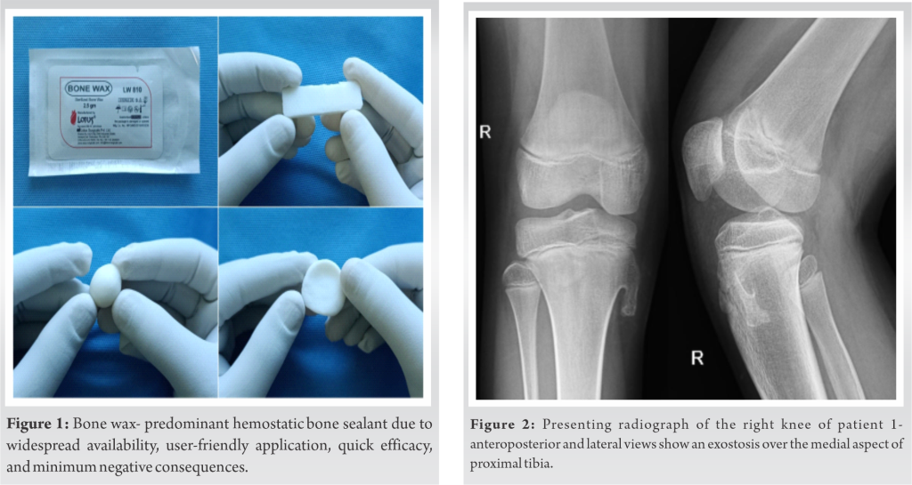 Beyond Hemostasis: Understanding the Risks of Bone Wax in Orthopedic ...