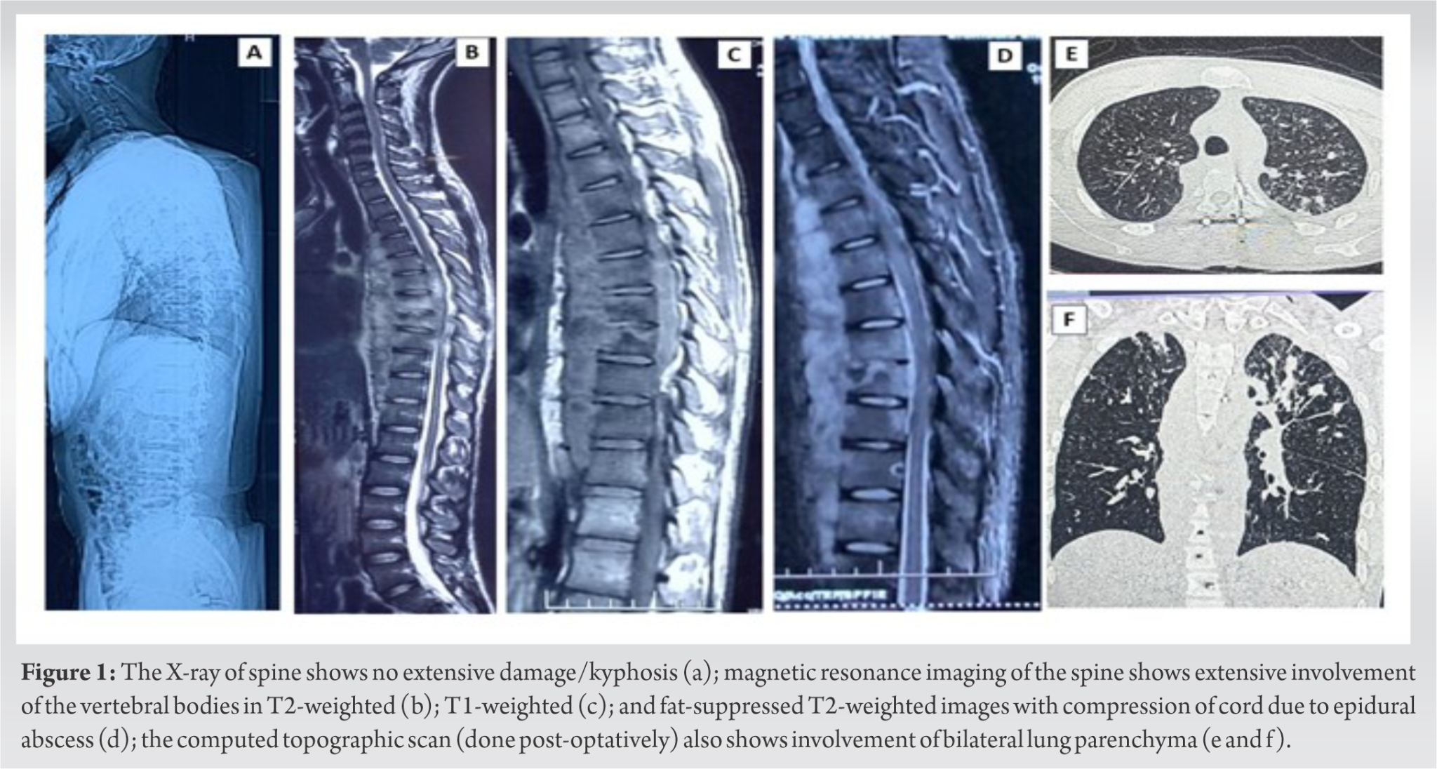 Long-segment Continuous Multi-level Spinal Tuberculosis without Bony ...