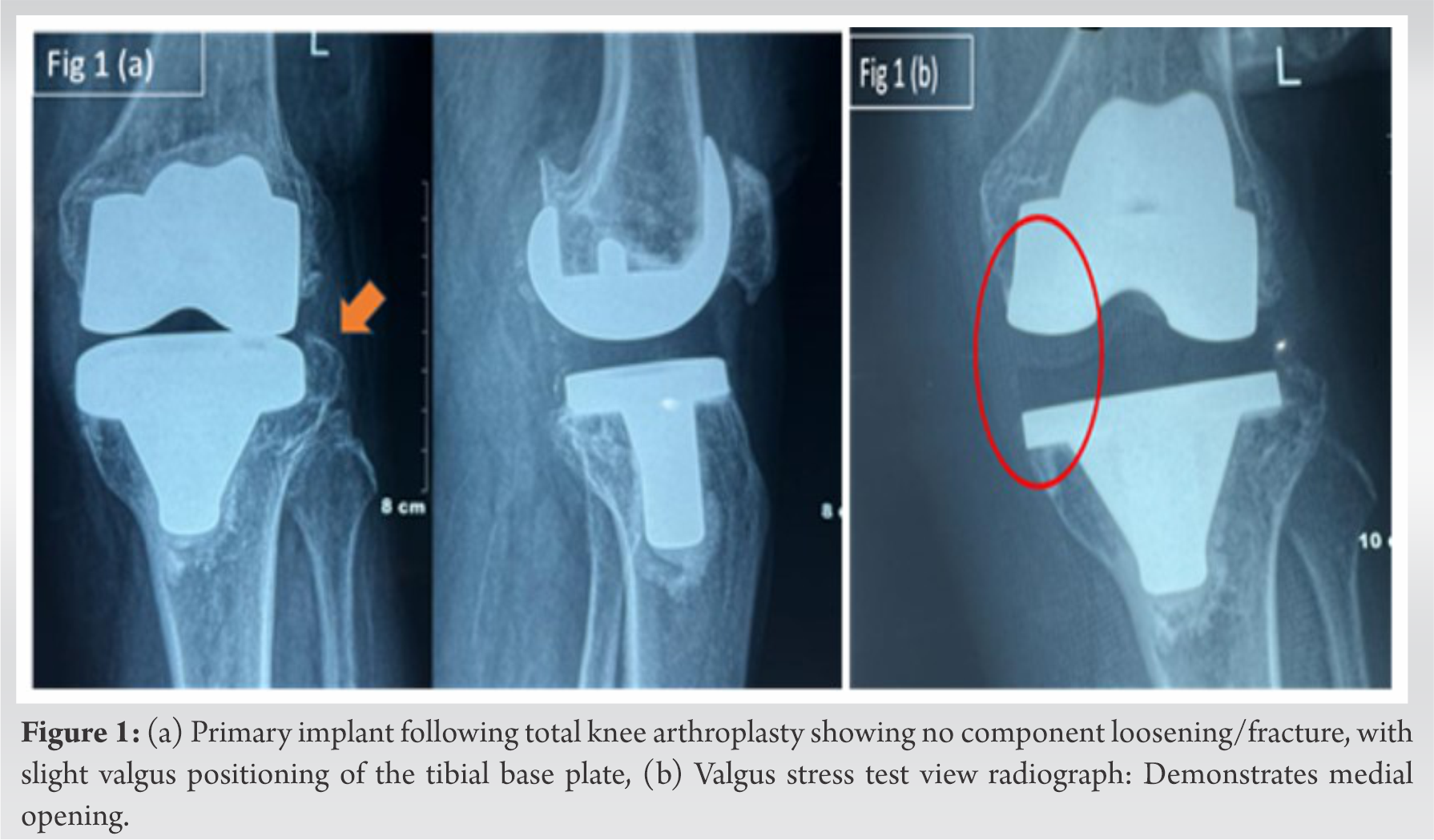 Erosion and Failure of the Tibial Post after Posterior-stabilized Total ...