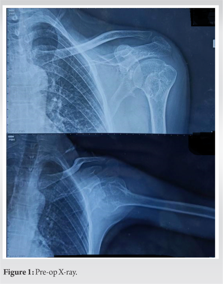 Locked Posterior Shoulder Dislocation with a Large Bone Defect in an ...