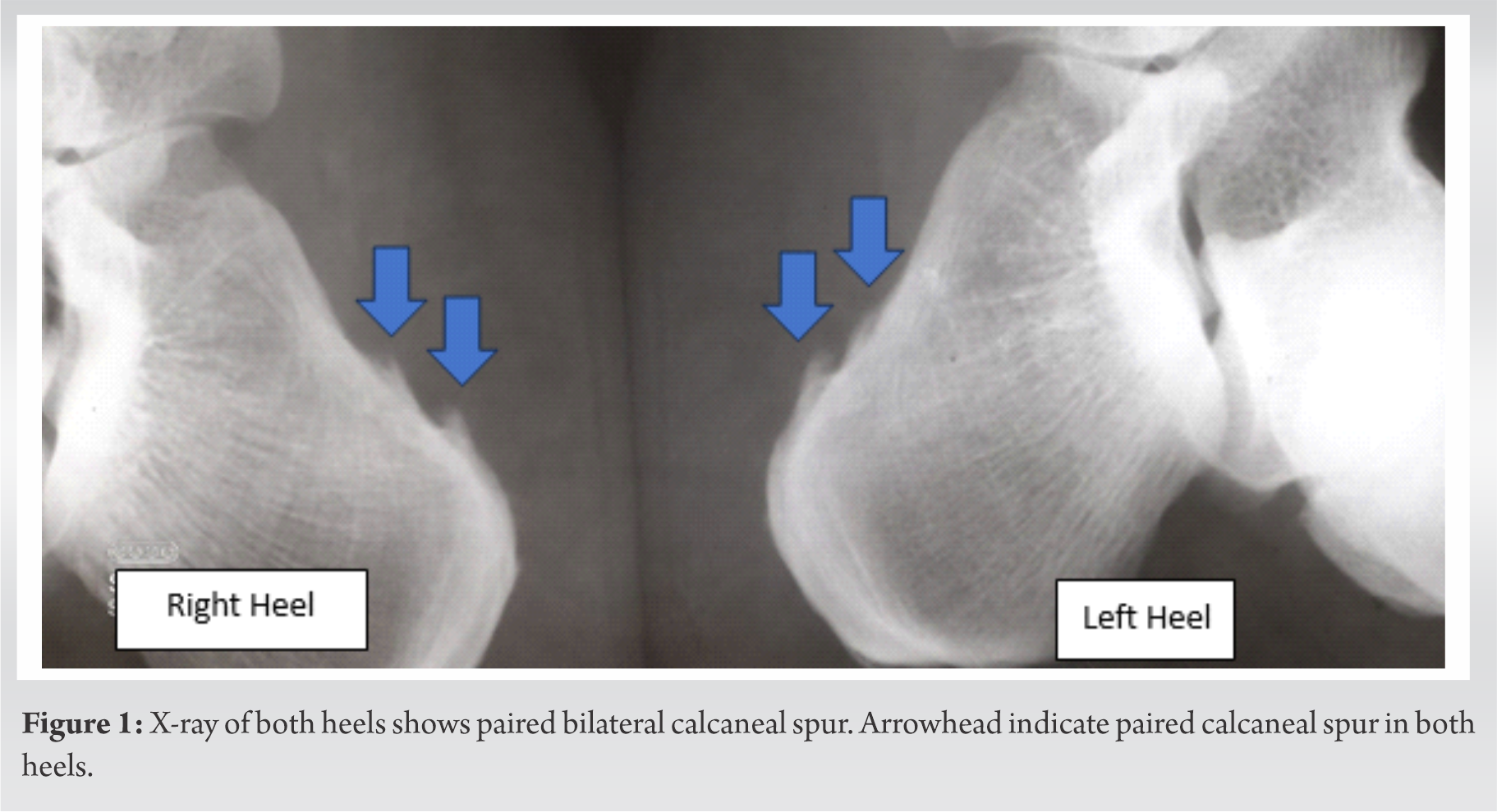 Bilateral Paired Calcaneal Spur: A Rare Entity | Journal of Orthopaedic ...